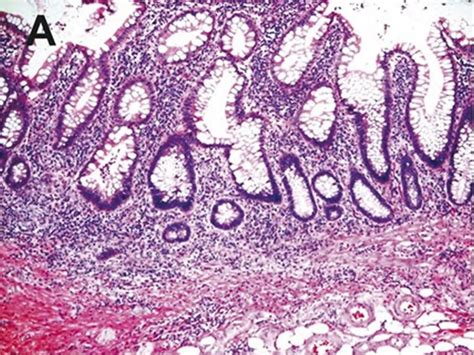 Ulcerative Proctitis Causes Symptoms Diagnosis Treatment Prognosis