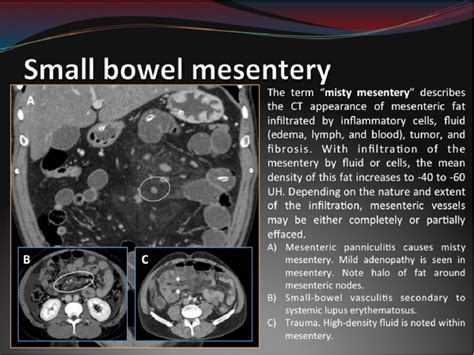 Figure 16 From Peritoneal Ligaments And Spaces A Comprehensive Review