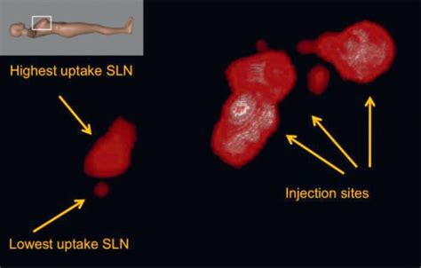 Showcase Of Intraoperative D Imaging Of The Sentinel Lymph Node In A Breast Cancer Patient