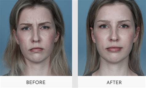 Diluted Botox The Risks And Fatalities In The Us