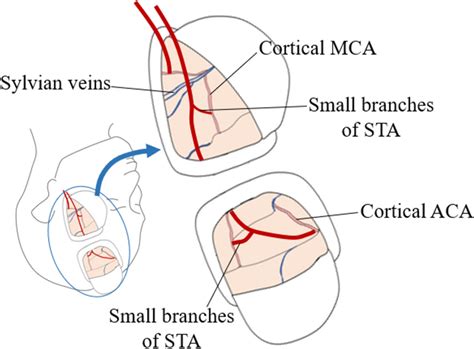 Schematic Of Sta Aca Bypass Aca Anterior Cerebral Artery Mca Middle Download Scientific