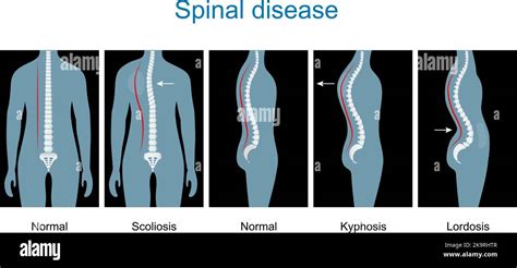 Spinal Disease Types Of Spine Defects Human Skeleton And Bones