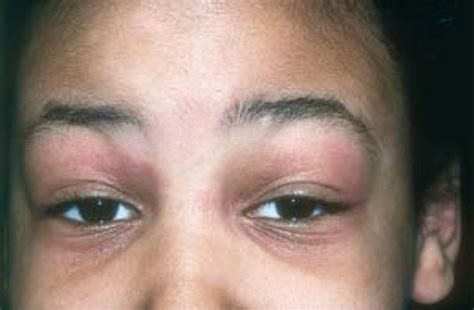 Lichenification Face