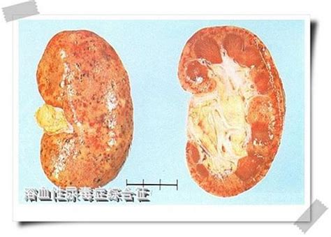 小儿溶血尿毒综合征【多图】39医疗图集 39健康网