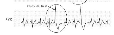Morphology Of The Pac Pjc And Pvc On Ecg Rhythms Premature