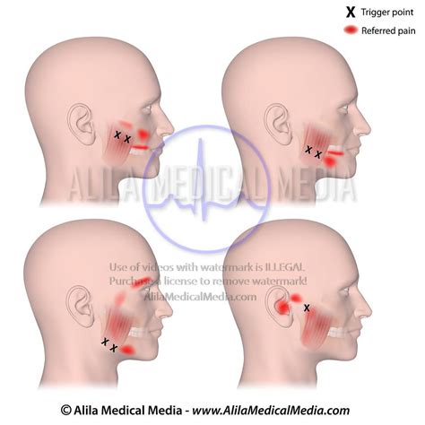 Alila Medical Media Trigger Points And Referred Pain Of The Masseters