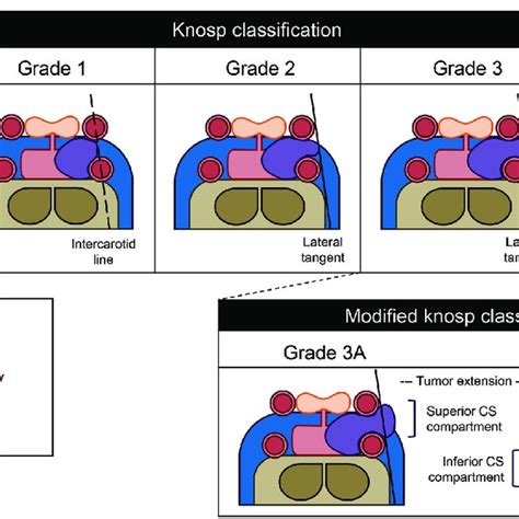 Knosp Classification And Modified Knosp Classification Knosp Download Scientific Diagram