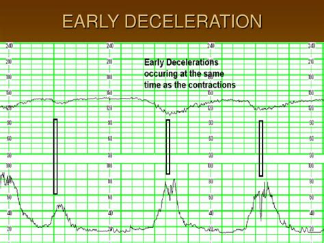 Ppt Electronic Fetal Monitoring Powerpoint Presentation Free