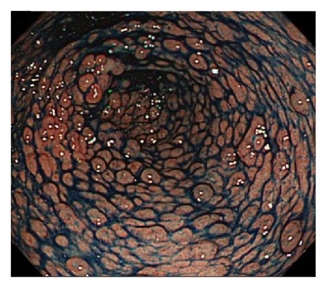 Endoscopic Views Of Case 1 A Colonoscopy Revealed Multiple Rectal Download Scientific