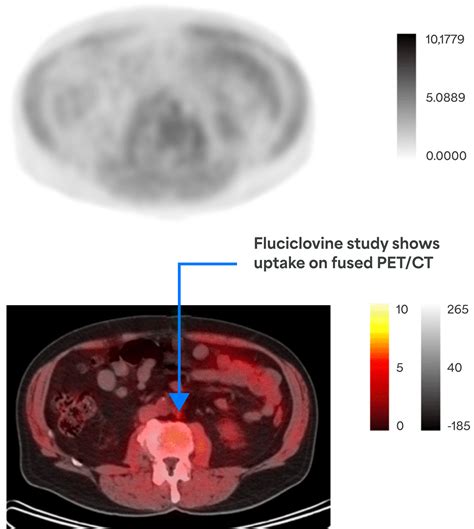 Pylarify® Case Studies Pylarify®