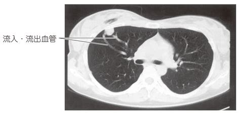 100f15 肺動静脈廔 国試 M3e Medical