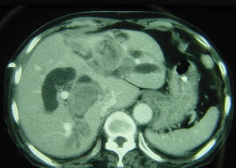 Cholangiohepatitis Surgery Photos