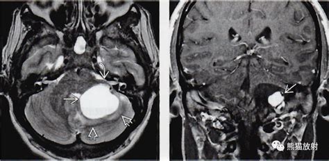 Vhl综合征、结节性硬化症：影像及临床诊断要点 Medsci Cn