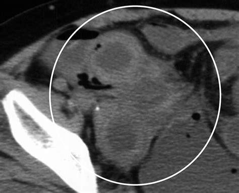 Ct Diagnosis Of Acute Mesenteric Ischemia From Various Causes Ajr