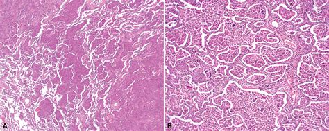 Chronic Diffuse Lung Diseases Clinical Tree