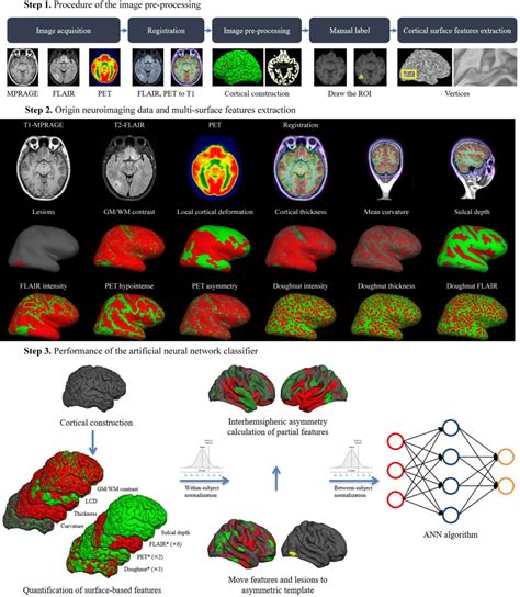 Automated Detection Of Focal Cortical Dysplasia With The Fcddetection Model Using Quantitative