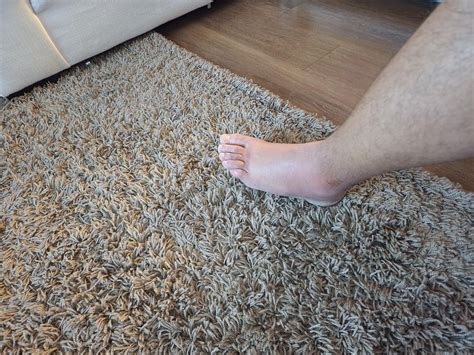 High Ankle Sprain Swelling Is Still Really Bad A Week Later Got X
