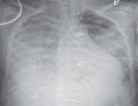 Cxr With Different Infiltrates Patterns During The Initial 24 Hours