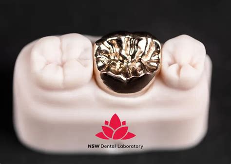 Comprehensive Understanding Of Gold Dental Crowns In Modern Dentistry