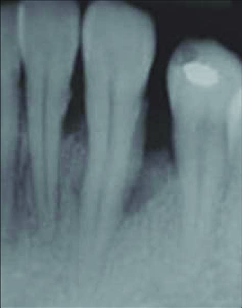 A Preoperative Radiographic View Showing A Vertical Bone Defect In A Download Scientific