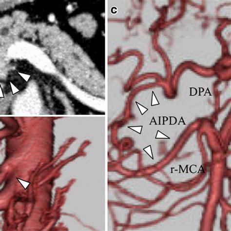 Preoperative Dynamic Ct Images A The Uncinate Process Communicating