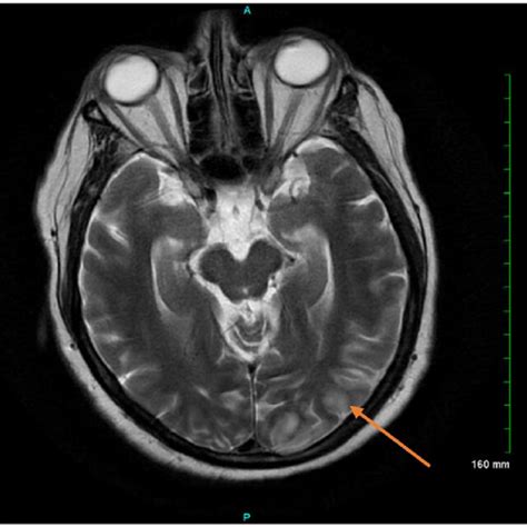Mri Brain T 2 Hyperintensity In Occipital Lobe Indicating Pres During