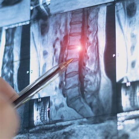 Pars Defect A Neurosurgical Overview
