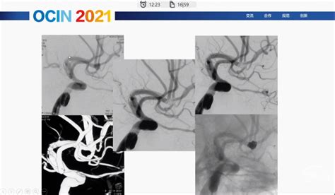 【建议收藏】神经介入手术操作技术：微导管微导丝操作基本技术 脑医汇
