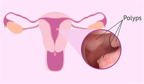 Bệnh Polyp Cổ Tử Cung Tổng quan nguyên nhân điều trị phòng ngừa