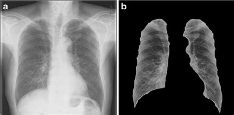 Results Of Lung Field Segmentation A Original Digital Chest Radiograph