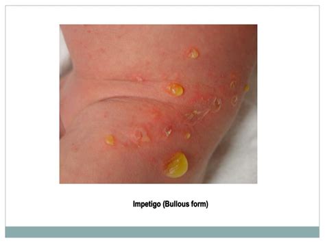 Ppt Common Skin Infections Powerpoint Presentation Free Download