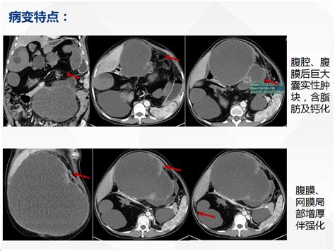 【病例】腹腔成熟型畸胎瘤合并腹膜胶质瘤病1例ct 影像ppt