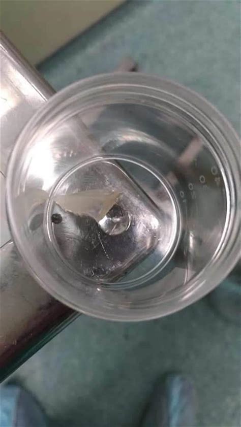 魚刺卡喉做這事食道恐二度傷害 嚴重要從頸部開刀取魚刺 健康 中時