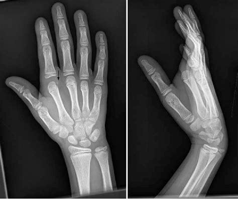Figure 1 From Pediatric Complex Metacarpophalangeal Joint Dislocation Of The Index Finger