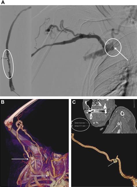 Visualization Of Dialysis Fistula By Computed Tomography Using Time