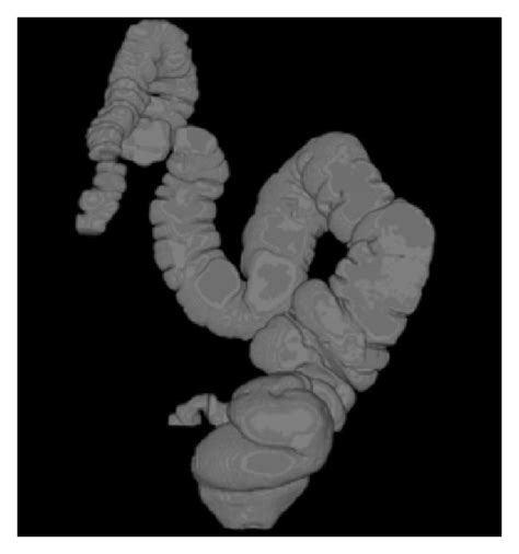 Segmentation Of The Colon When There Is A Polyp In The Cecum