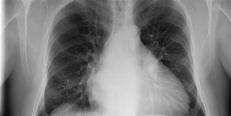Cardiomegaly Disease Prediction Using Cnn Kaggle