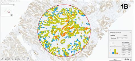 Combined Manual Reading And Computer Aided Quantitative Analysis For The Standardization Of Her2