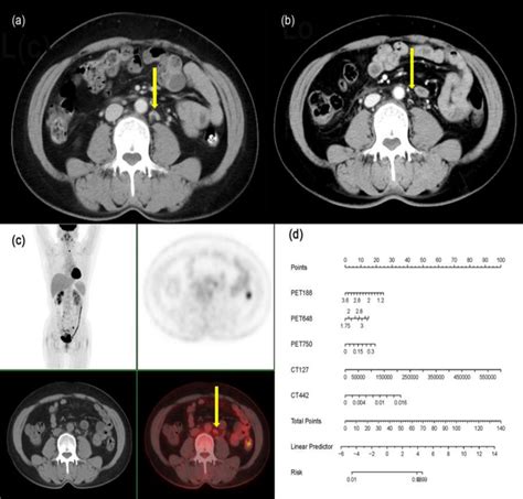 The Yellow Arrows Indicate The Para Aortic Lymph Node The Patient A