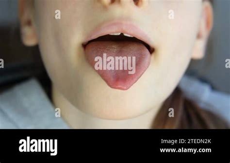 Wide Open Mouth With A Tongue Stuck Out View Of The Uvula And The Soft