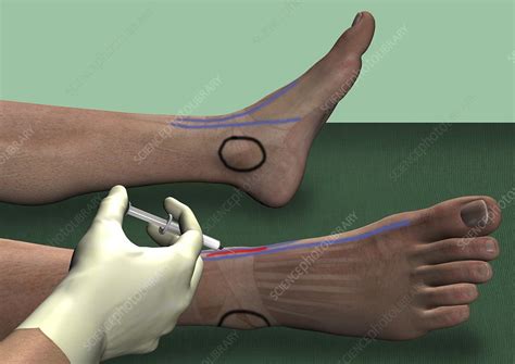 Deep Fibular Nerve Block Artwork Stock Image C016 6833 Science Photo Library