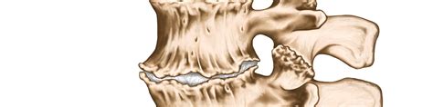 Artrosis Lumbar Qué Es Causas Síntomas Tratamiento Y Consejos