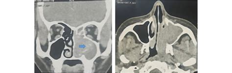 A Contrast Enhanced Ct Scan Of The Nose And Pns Revealed Minimal