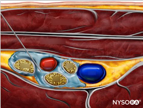 Infraclavicular Block Diagram Quizlet