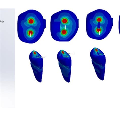 Stress Distribution Patterns A Solid Model B Caries Driven Model Download Scientific Diagram