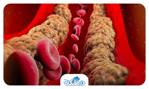 تری گلیسیرید Triglycerides؛ رژیم غذایی Tg، علائم، درمان