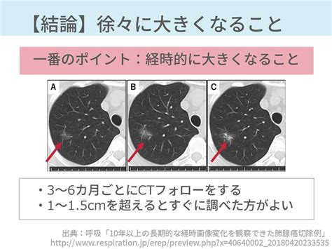 胸部ct、肺癌
