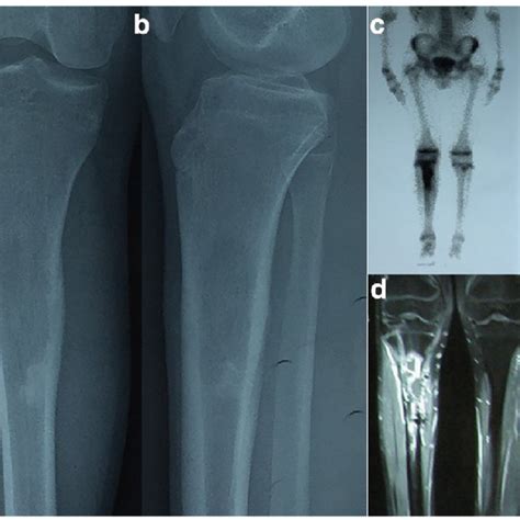 Pdf Uncemented Three Dimensional Printed Prosthetic Reconstruction