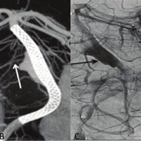 Overview Of Intrasaccular Flow Diversion Disruption Devices Download Scientific Diagram