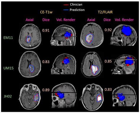 A Fully Automated Post Surgical Brain Tumor Segmentation Model For